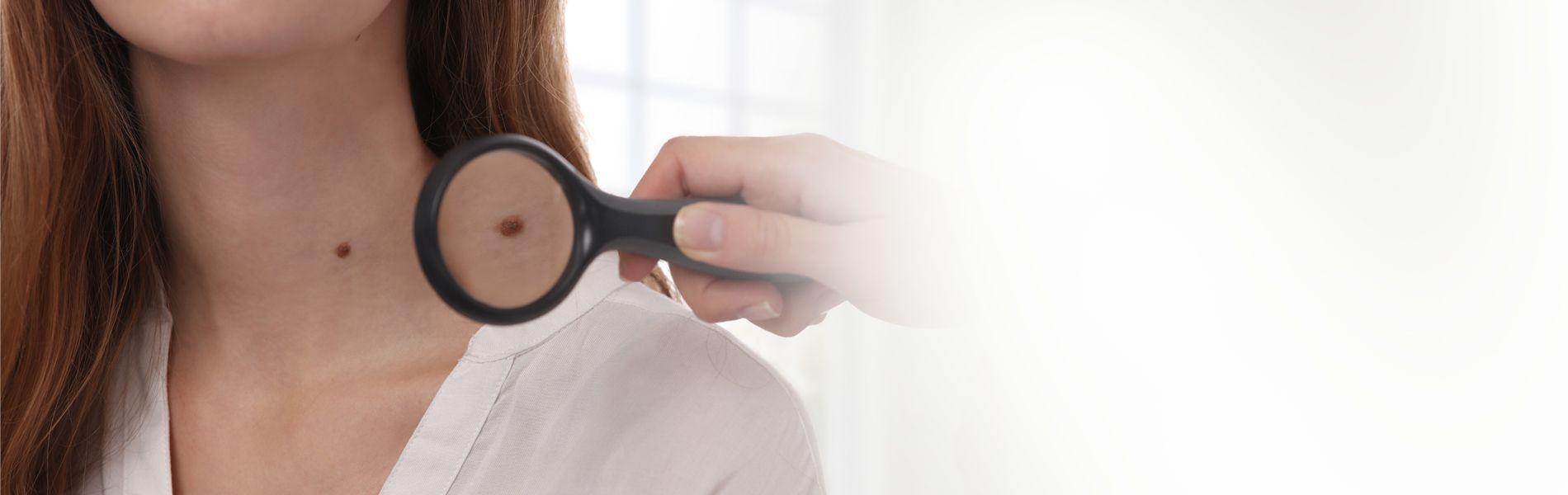 How Are Genital Warts Different From Skin Tags?