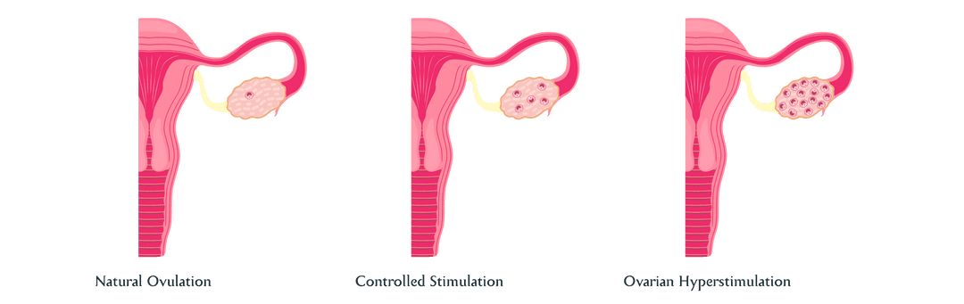 Ovarian Hyperstimulation Syndrome (OHSS) Causes, Symptoms, Risks ...