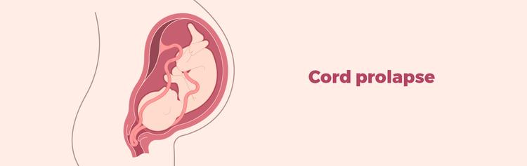 Umbilical Cord Prolapse: Causes, Diagnosis & Management