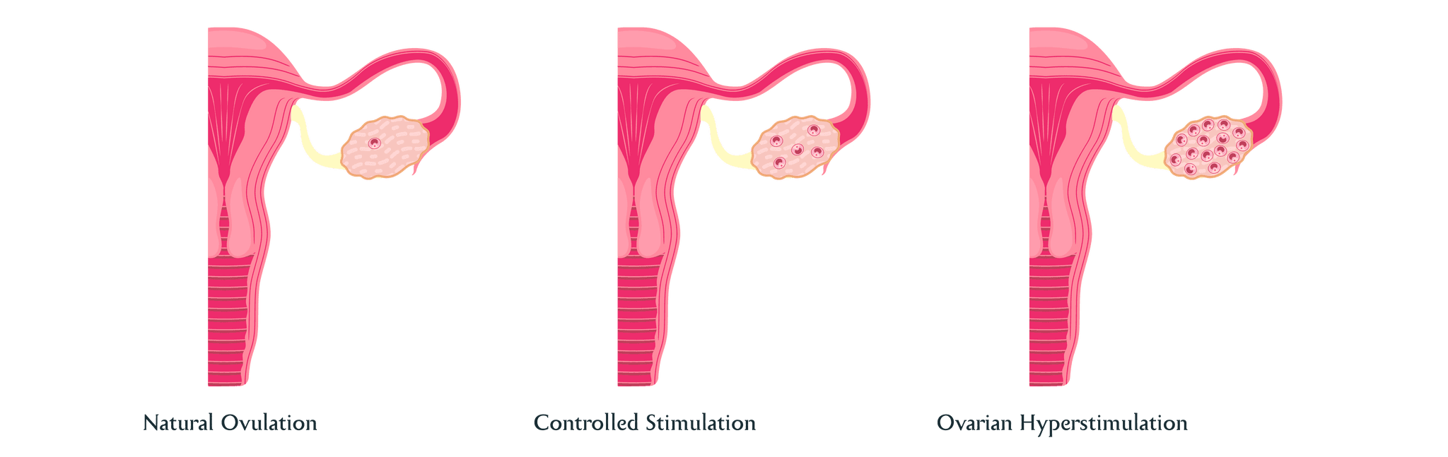Ovarian Hyperstimulation Syndrome (OHSS) Causes, Symptoms, Risks, Treatment and Prevention